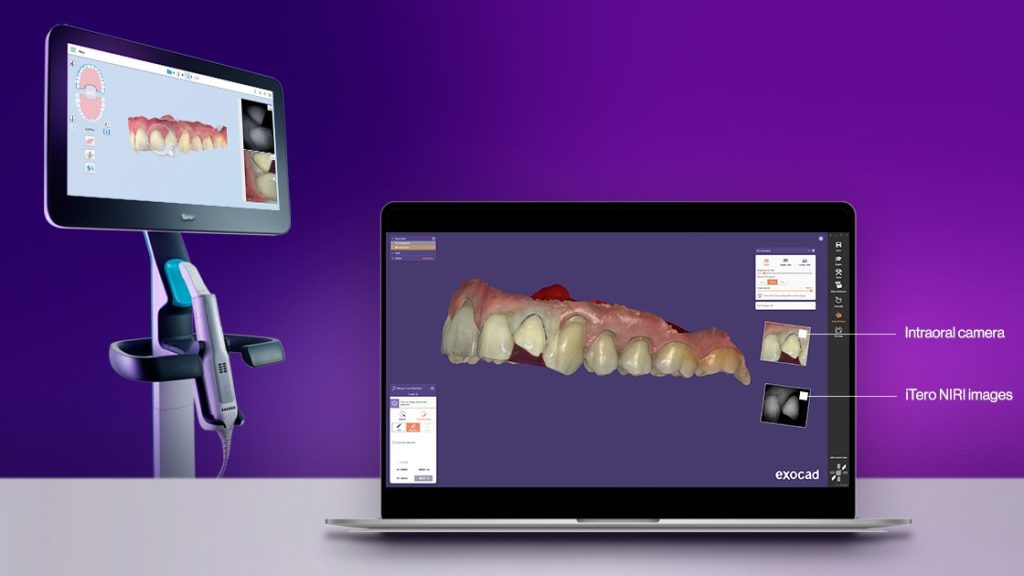Align Technology integra câmara intraoral e imagens NIRI no iTero-Exocad Connector – Saúde Oral